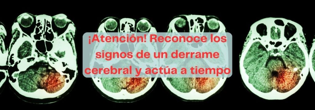 Derrame cerebral: Identifica los síntomas y actúa rápidamente